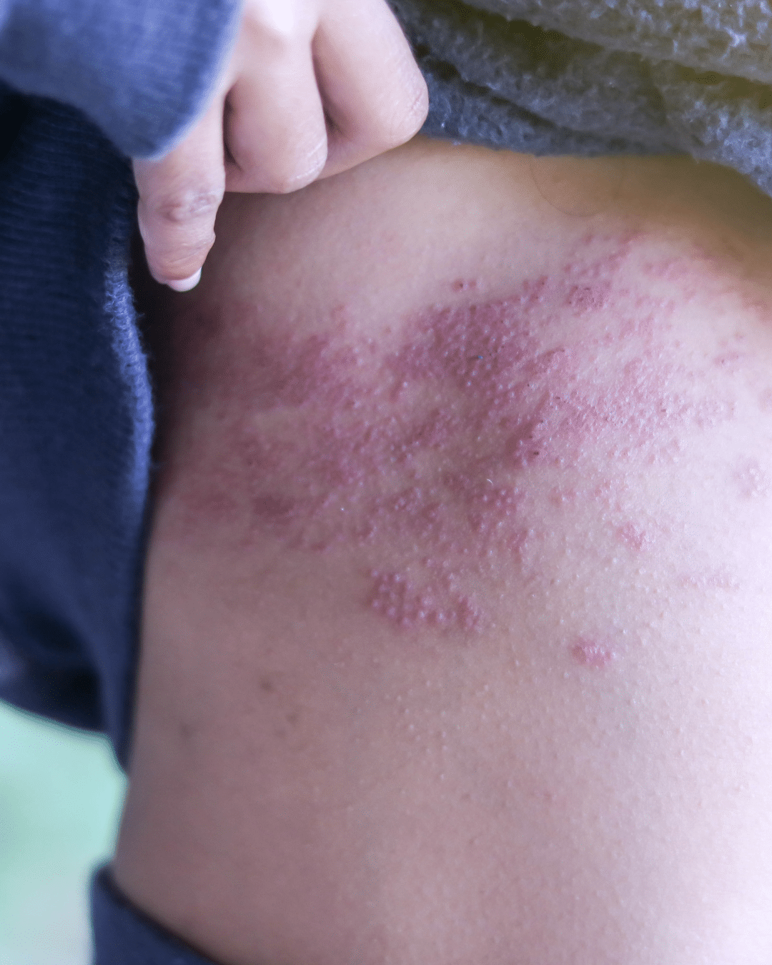 Conociendo la histamina: causas, síntomas y control | AilinHealth