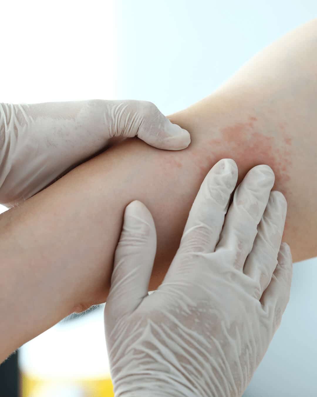 Conociendo la histamina: causas, síntomas y control | AilinHealth